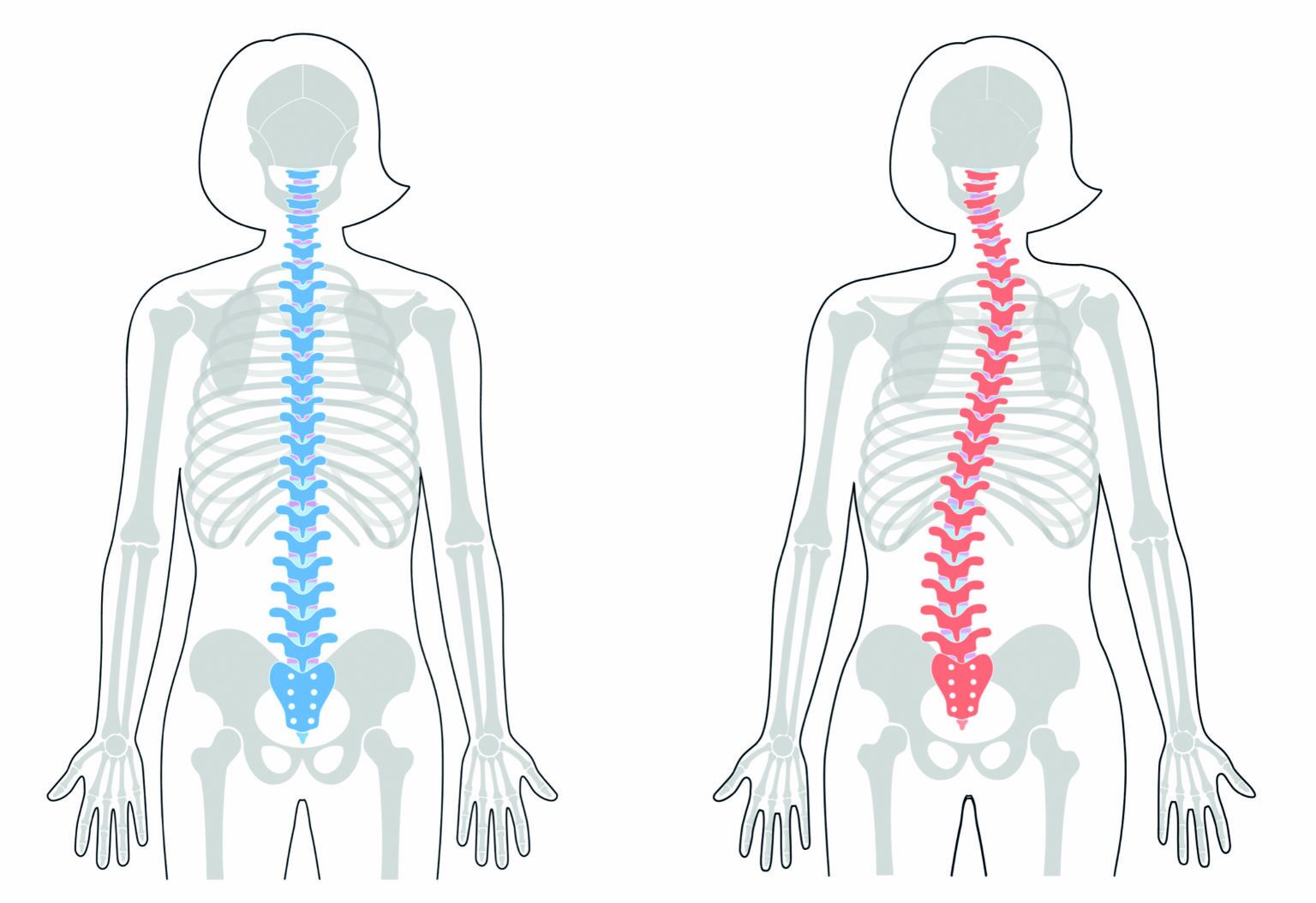 Yoga and Reverse S Curve Scoliosis | Om Yoga Magazine